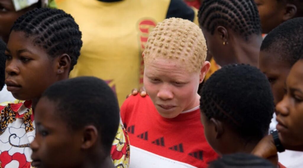 ALBINISM: DISCRIMINATION IN AFRICA - Volunteer in the world